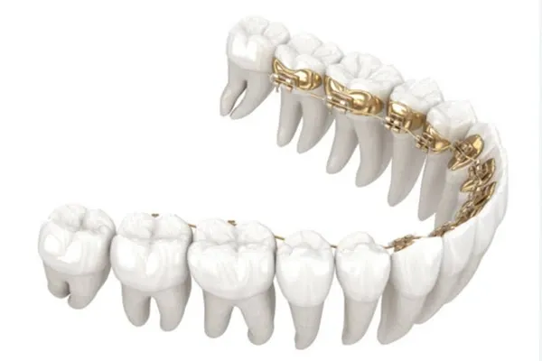 lingual braces deep overbite