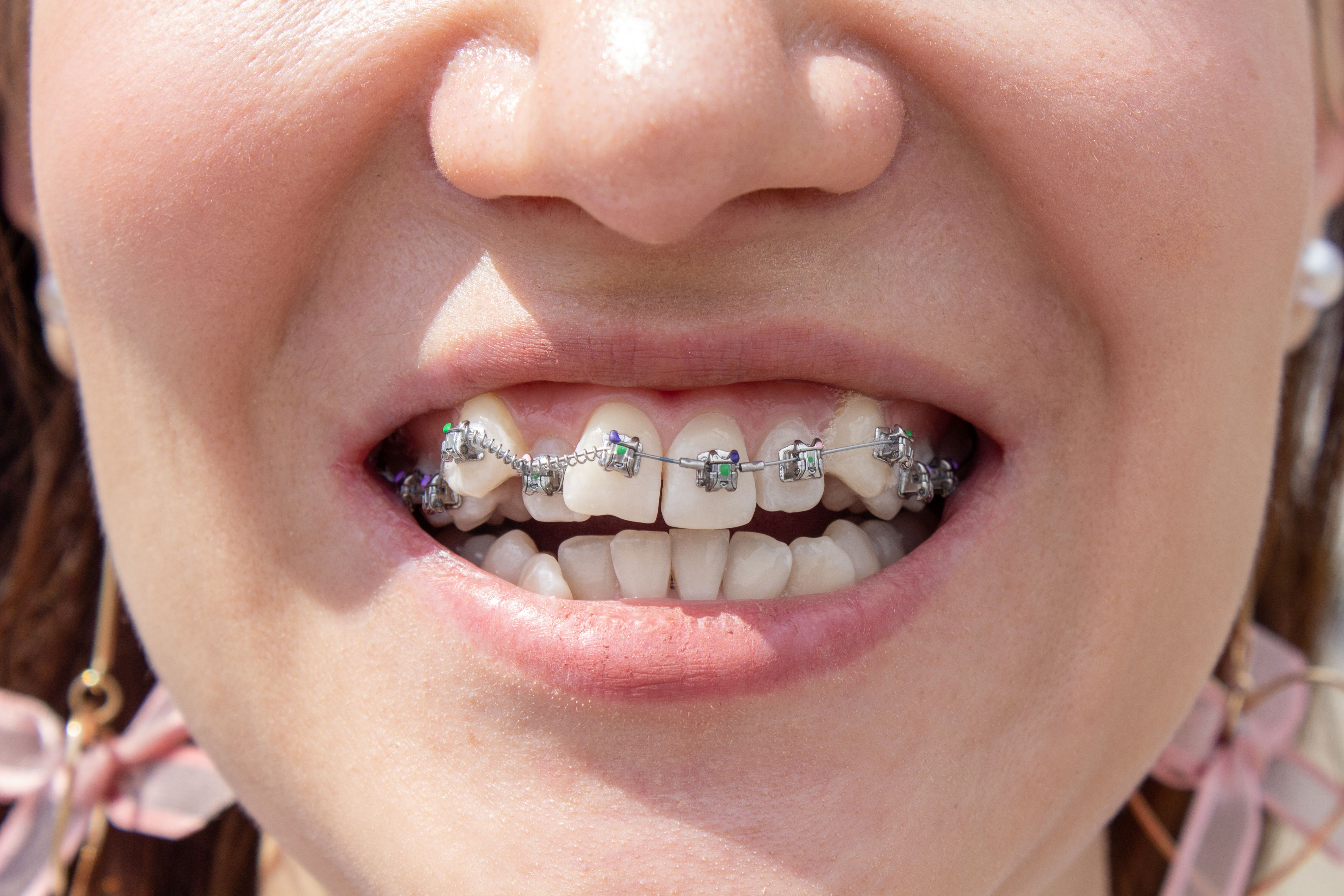 invisalign braces for overbite